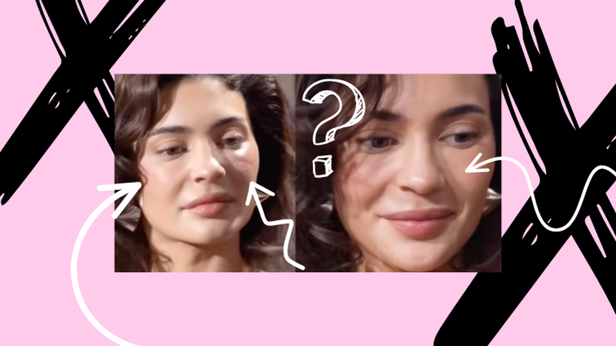 Pillow face: le visage de Kylie Jenner touché par ce phénomène