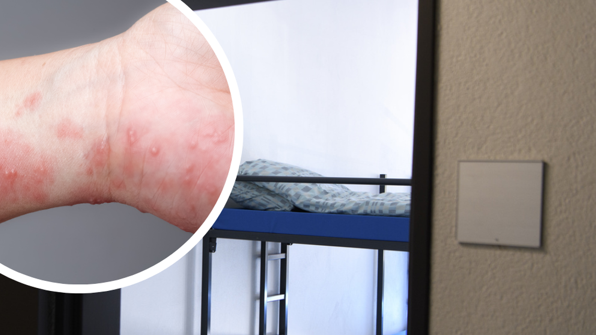 Les centres d'asile suisses victimes d'une épidémie de gale