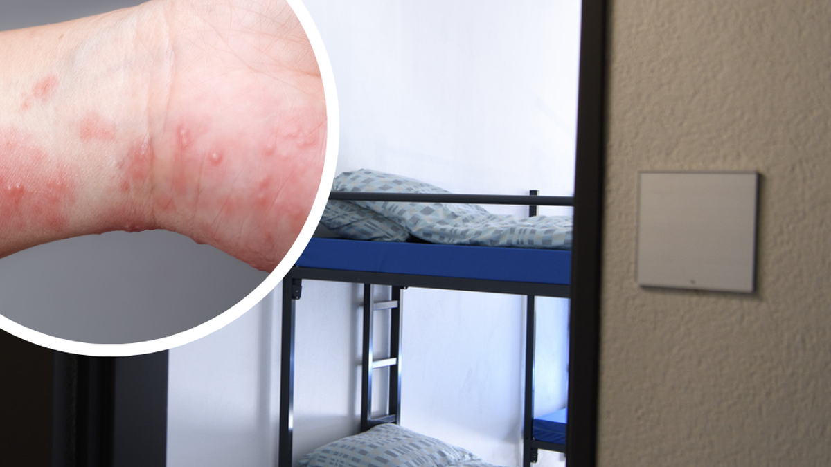 Les centres d'asile suisses victimes d'une épidémie de gale