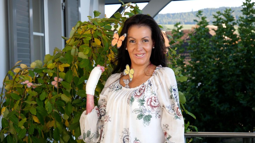 Michelle Zimmermann hat die Schmetterlingskrankheit