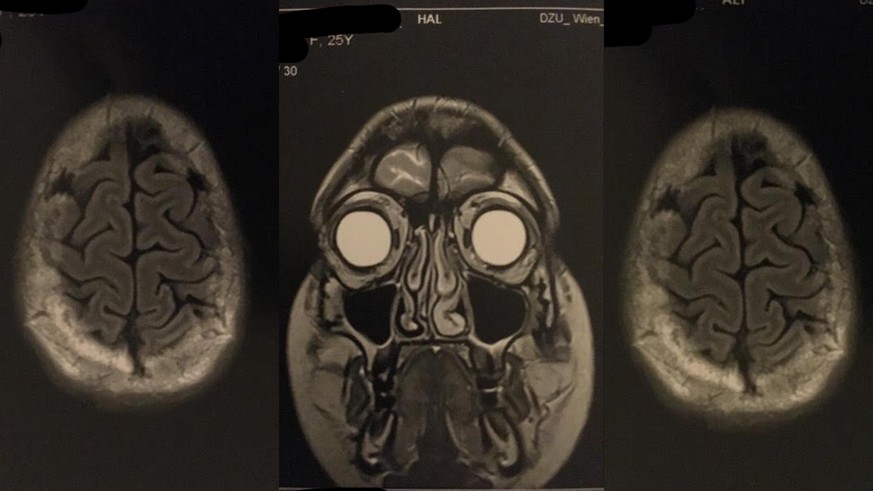 Diagnose Gehirntumor: So fühlt es sich an, am Gehirn operiert zu werden