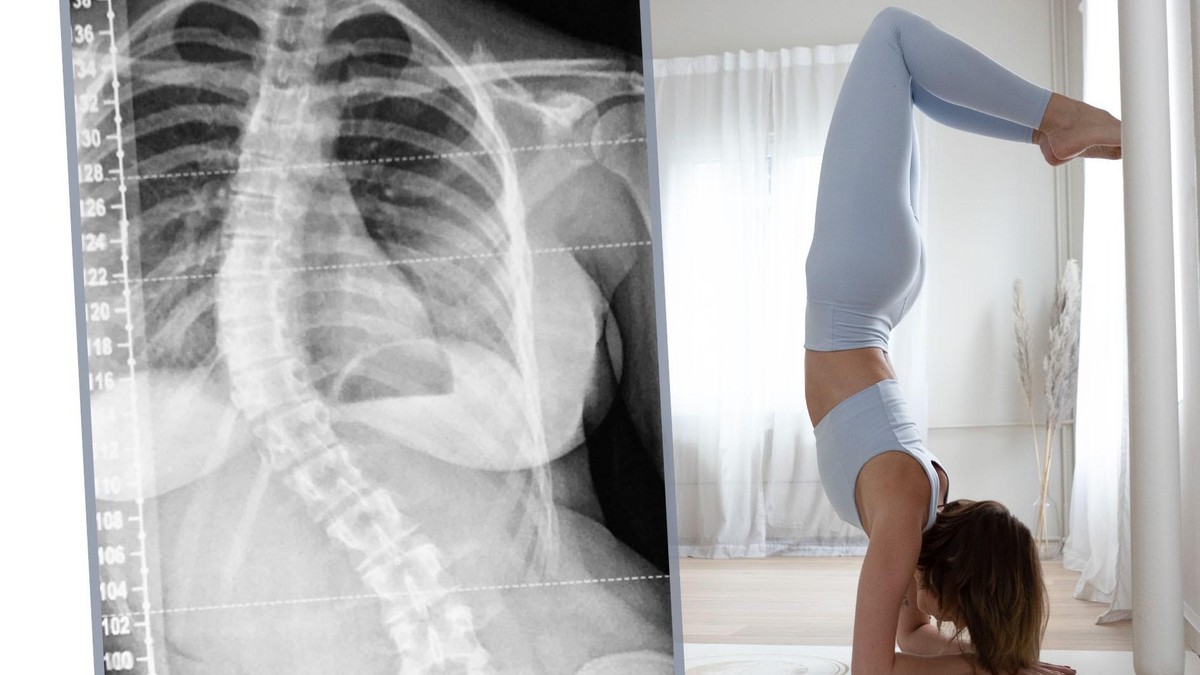 Skoliose: Vom Kind mit gekrümmter Wirbelsäule zur Yogalehrerein Skoliose: Vom Kind mit gekrümmter Wirbelsäule zur Yogalehrerein